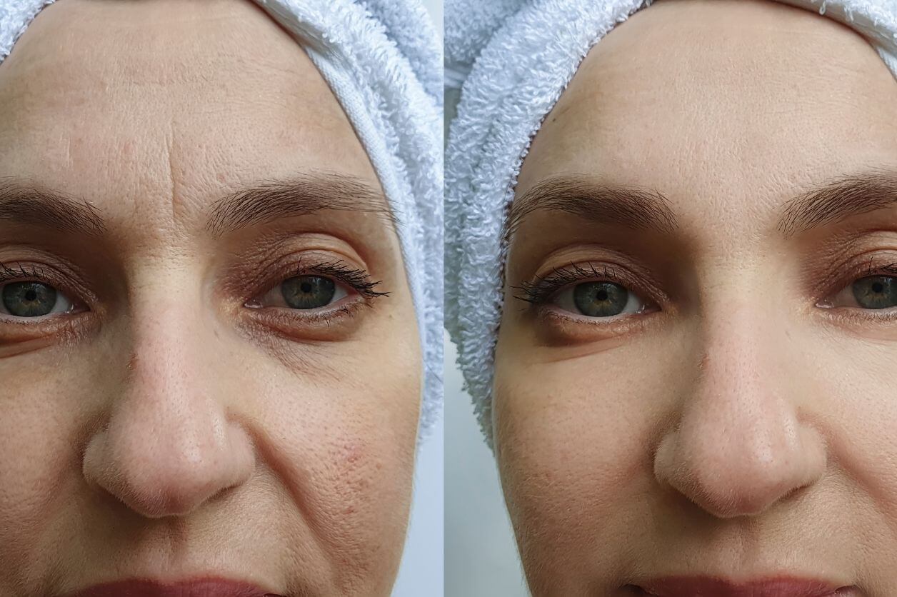 Decoding Beauty Injections Botox And Dysport Explained